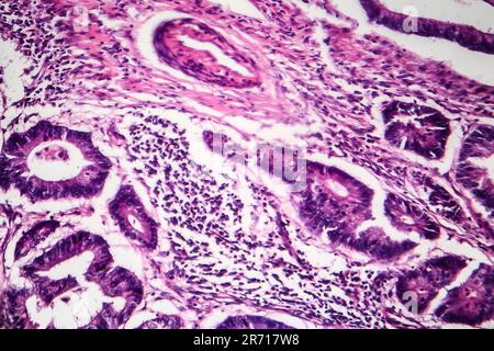Colon cancer, light micrograph, photo under microscope Stock Photo - Alamy