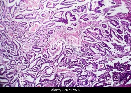 Colon cancer, light micrograph, photo under microscope Stock Photo - Alamy