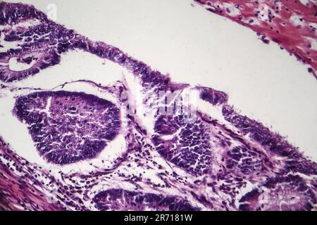 Colon cancer, light micrograph, photo under microscope Stock Photo - Alamy