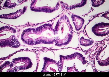 Colon cancer, light micrograph, photo under microscope Stock Photo - Alamy