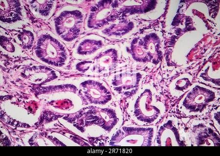 Colon cancer, light micrograph, photo under microscope Stock Photo - Alamy