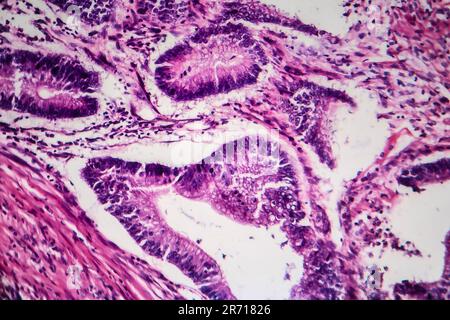 Colon cancer, light micrograph, photo under microscope Stock Photo - Alamy
