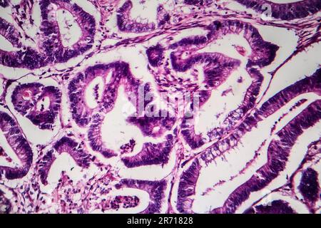 Colon cancer, light micrograph, photo under microscope Stock Photo - Alamy