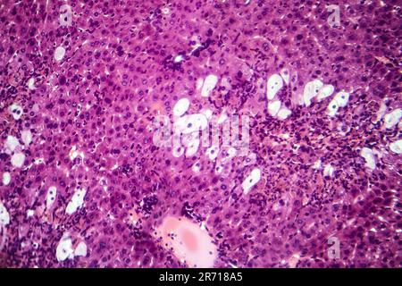 Viral hepatitis, light micrograph, photo under microscope Stock Photo ...