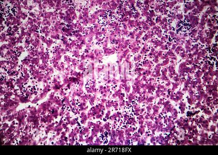 Histopathology of chronic active hepatitis, light micrograph, photo ...