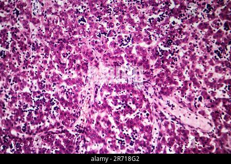 Histopathology of chronic active hepatitis, light micrograph, photo ...