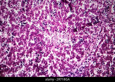 Histopathology of chronic active hepatitis, light micrograph, photo ...