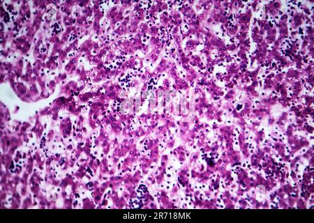 Histopathology of chronic active hepatitis, light micrograph, photo ...