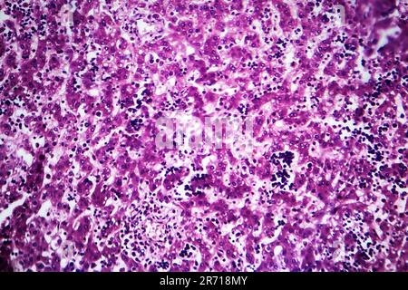 Histopathology of chronic active hepatitis, light micrograph, photo ...