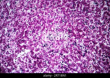 Histopathology of chronic active hepatitis, light micrograph, photo ...
