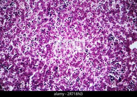Histopathology of chronic active hepatitis, light micrograph, photo ...