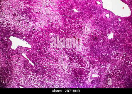 Histopathology of subacute severe hepatitis, light micrograph, photo ...