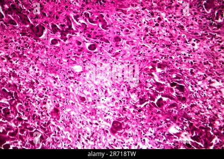 Histopathology of subacute severe hepatitis, light micrograph, photo ...