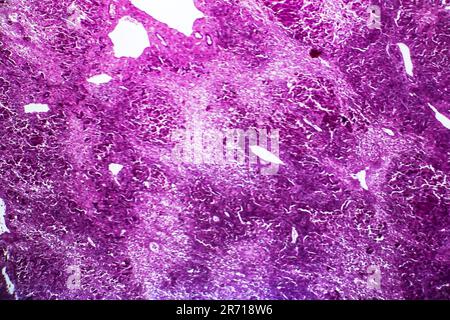 Histopathology of subacute severe hepatitis, light micrograph, photo ...