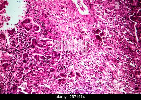 Histopathology of subacute severe hepatitis, light micrograph, photo ...