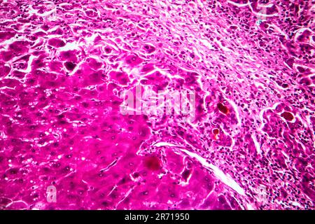 Histopathology of subacute severe hepatitis, light micrograph, photo ...