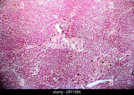 Histopathology of acute severe hepatitis, light micrograph, photo under ...