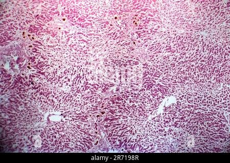 Histopathology of acute severe hepatitis, light micrograph, photo under ...