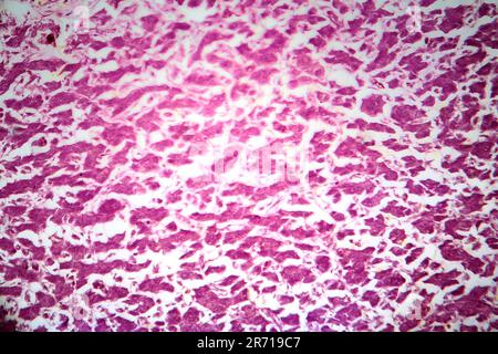 Histopathology of acute severe hepatitis, light micrograph, photo under ...