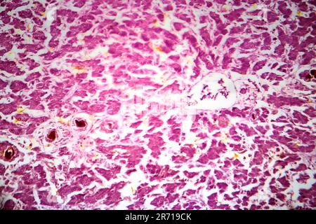 Histopathology of acute severe hepatitis, light micrograph, photo under ...