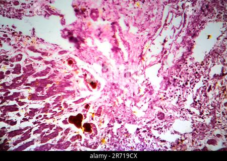 Histopathology of acute severe hepatitis, light micrograph, photo under ...