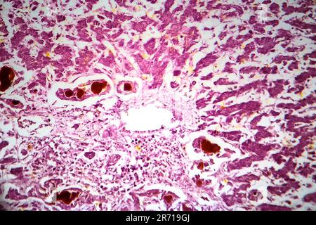 Histopathology of acute severe hepatitis, light micrograph, photo under ...