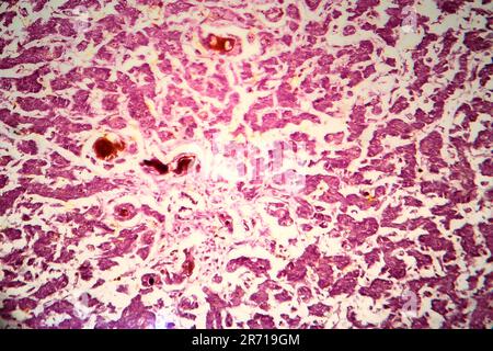 Histopathology of acute severe hepatitis, light micrograph, photo under ...