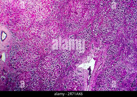 Histopathology of biliary liver cirrhosis, light micrograph, photo ...