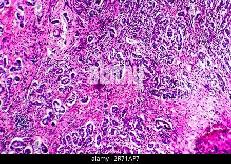 Histopathology of biliary liver cirrhosis, light micrograph, photo ...