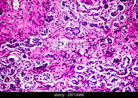 Histopathology of biliary liver cirrhosis, light micrograph, photo ...