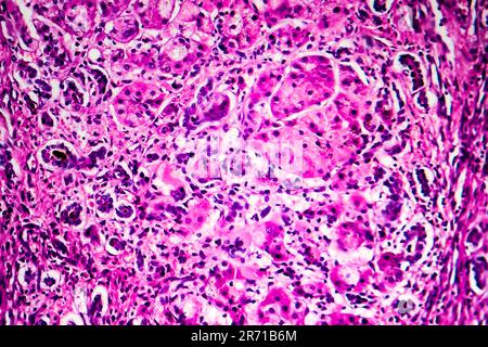 Histopathology of biliary liver cirrhosis, light micrograph, photo ...