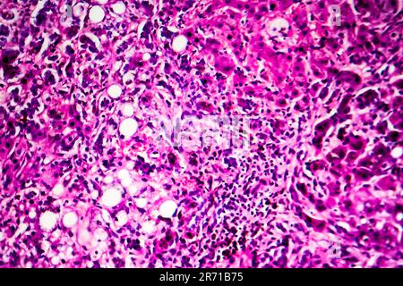 Histopathology of biliary liver cirrhosis, light micrograph, photo ...