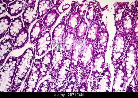 Bacillary dysentery, light micrograph, photo under microscope showing ...