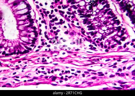 Bacillary dysentery, light micrograph, photo under microscope showing ...