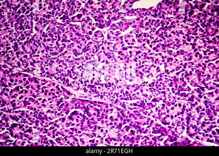 Hepatocellular carcinoma, cancer of liver, light micrograph, photo ...