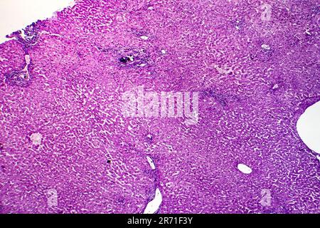 Liver schistosomiasis, light micrograph, photo under microscope showing ...