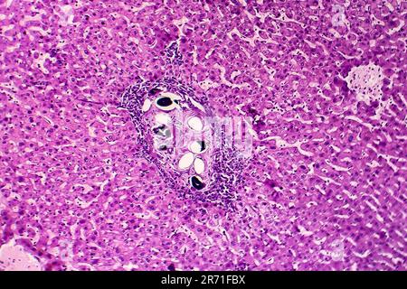 Liver schistosomiasis, light micrograph, photo under microscope showing ...