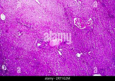 Liver edema, light micrograph, photo under microscope Stock Photo - Alamy