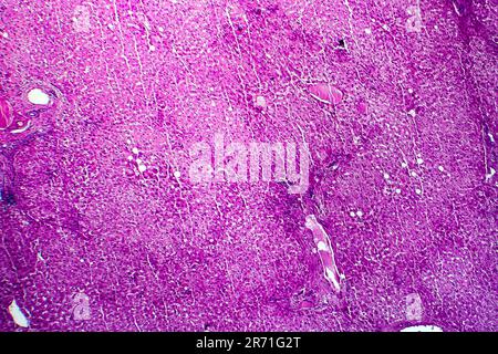 Liver edema, light micrograph, photo under microscope Stock Photo - Alamy