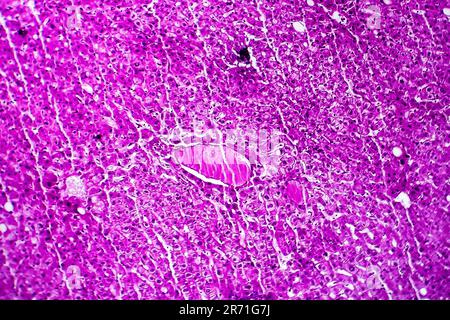 Liver edema, light micrograph, photo under microscope Stock Photo - Alamy