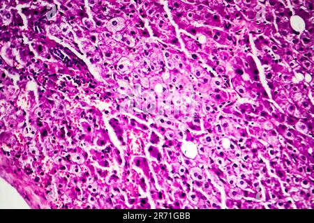Liver edema, light micrograph, photo under microscope Stock Photo - Alamy