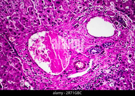 Liver edema, light micrograph, photo under microscope Stock Photo - Alamy