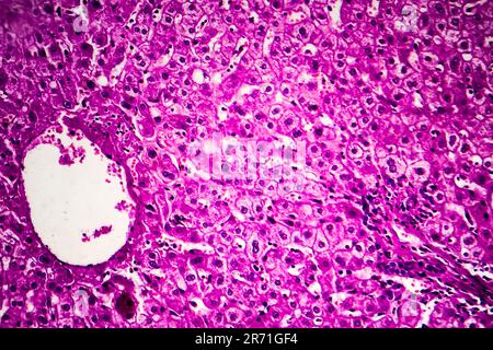 Liver edema, light micrograph, photo under microscope Stock Photo - Alamy