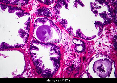 Benign prostatic hyperplasia, light micrograph, photo under microscope ...