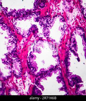 Prostate hyperplasia. Photomicrograph showing dilated glands, papillary ...