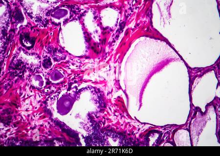 Prostate hyperplasia. Photomicrograph showing dilated glands, enfolding ...