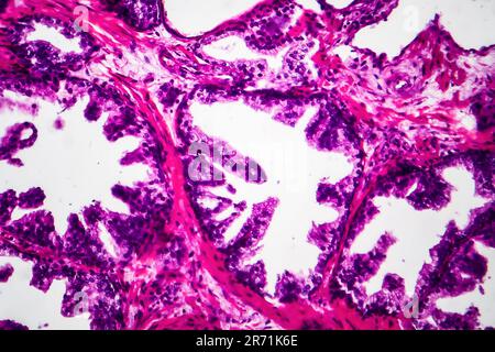 Benign prostatic hyperplasia, light micrograph, photo under microscope ...