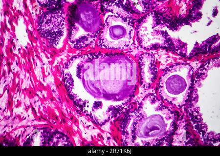 Prostate hyperplasia. Photomicrograph showing dilated glands, papillary ...