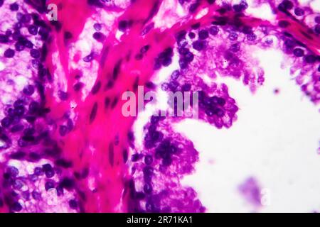 Benign prostatic hyperplasia, light micrograph, photo under microscope ...
