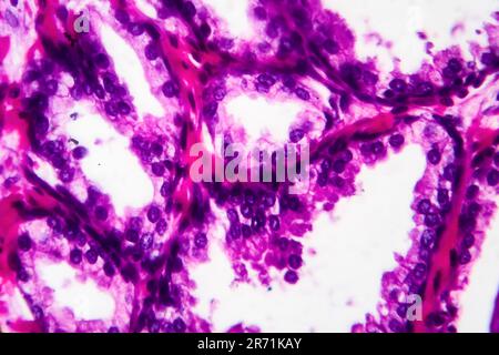 Benign Prostatic Hyperplasia Histology